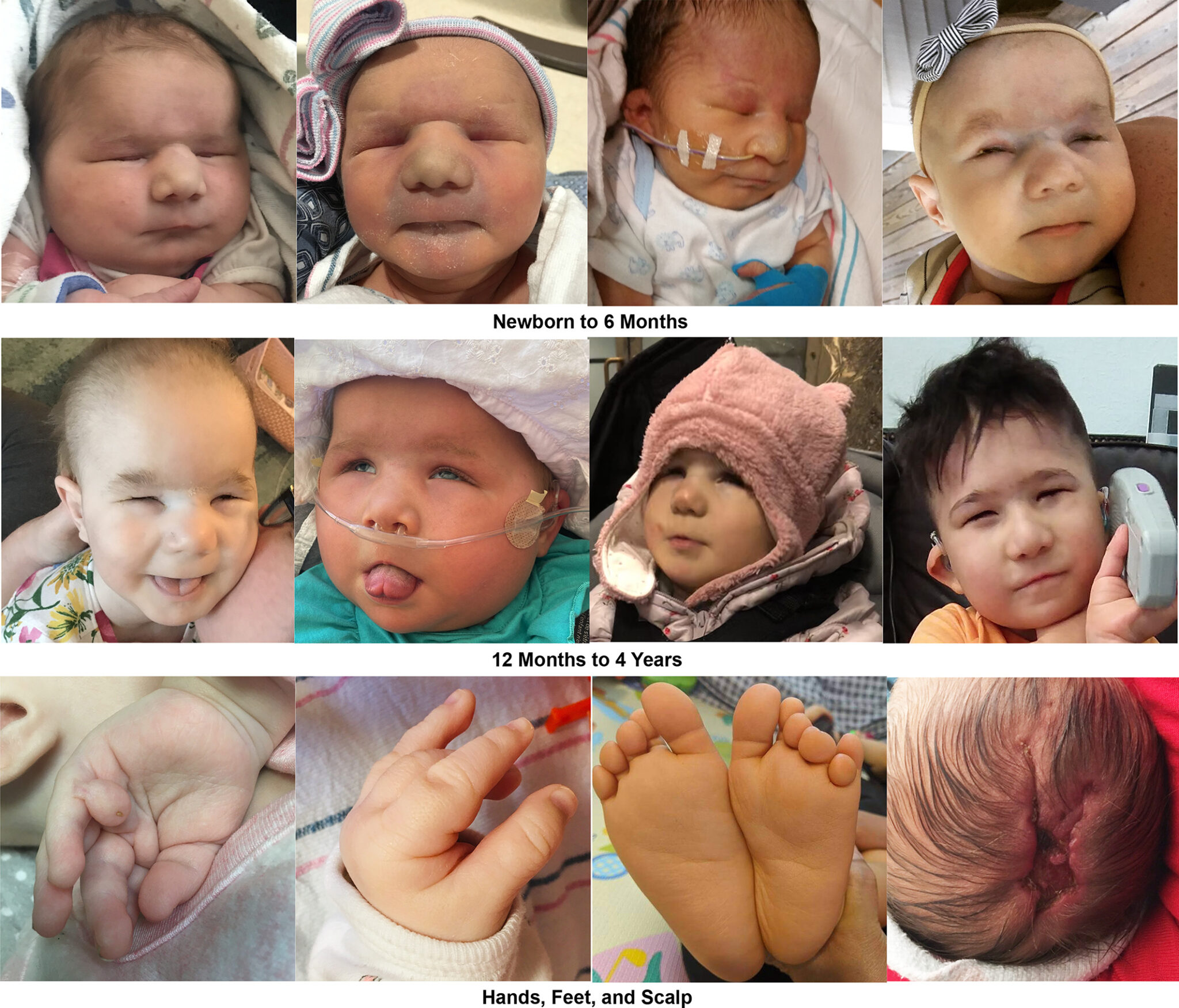 Hội chứng Patau (Trisomy 13) - Gene Solutions Việt Nam